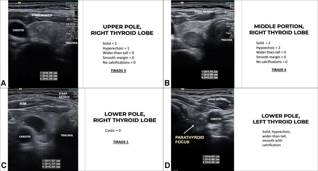 A 65-year-old Female with Spontaneously Resolving Hyperparathyroidism ...